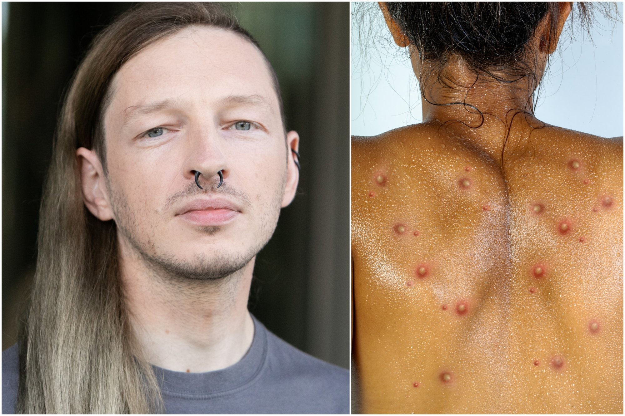 Dudas paaiškino, kaip plinta beždžionių raupai ir kas jiems imliausi ...