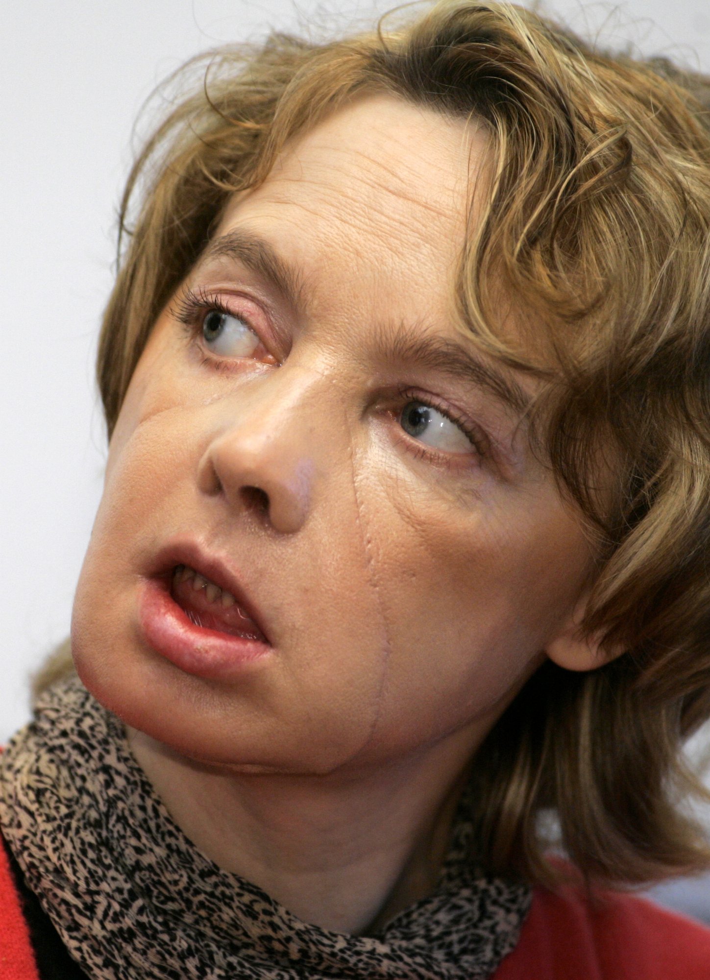 Pirmosios pasaulyje veido persodinimo operacijos pacientės išpažintis ...