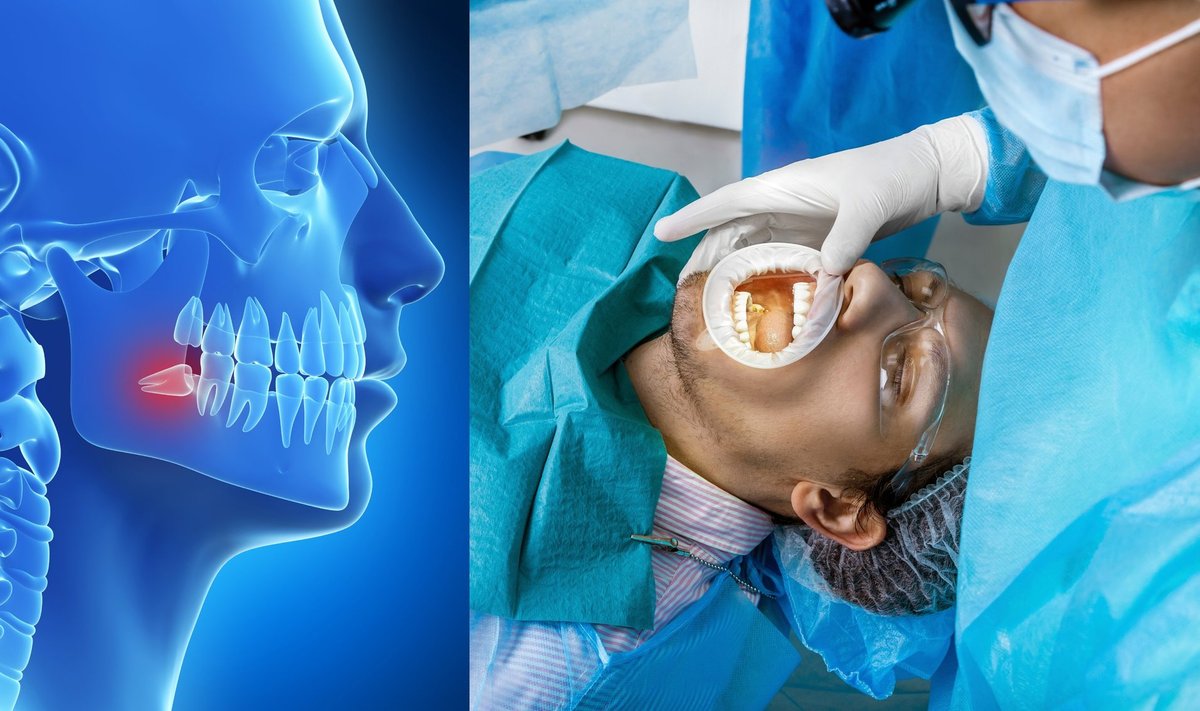 Gydyti ar šalinti: visa tiesa apie protinius dantis - Delfi sveikata