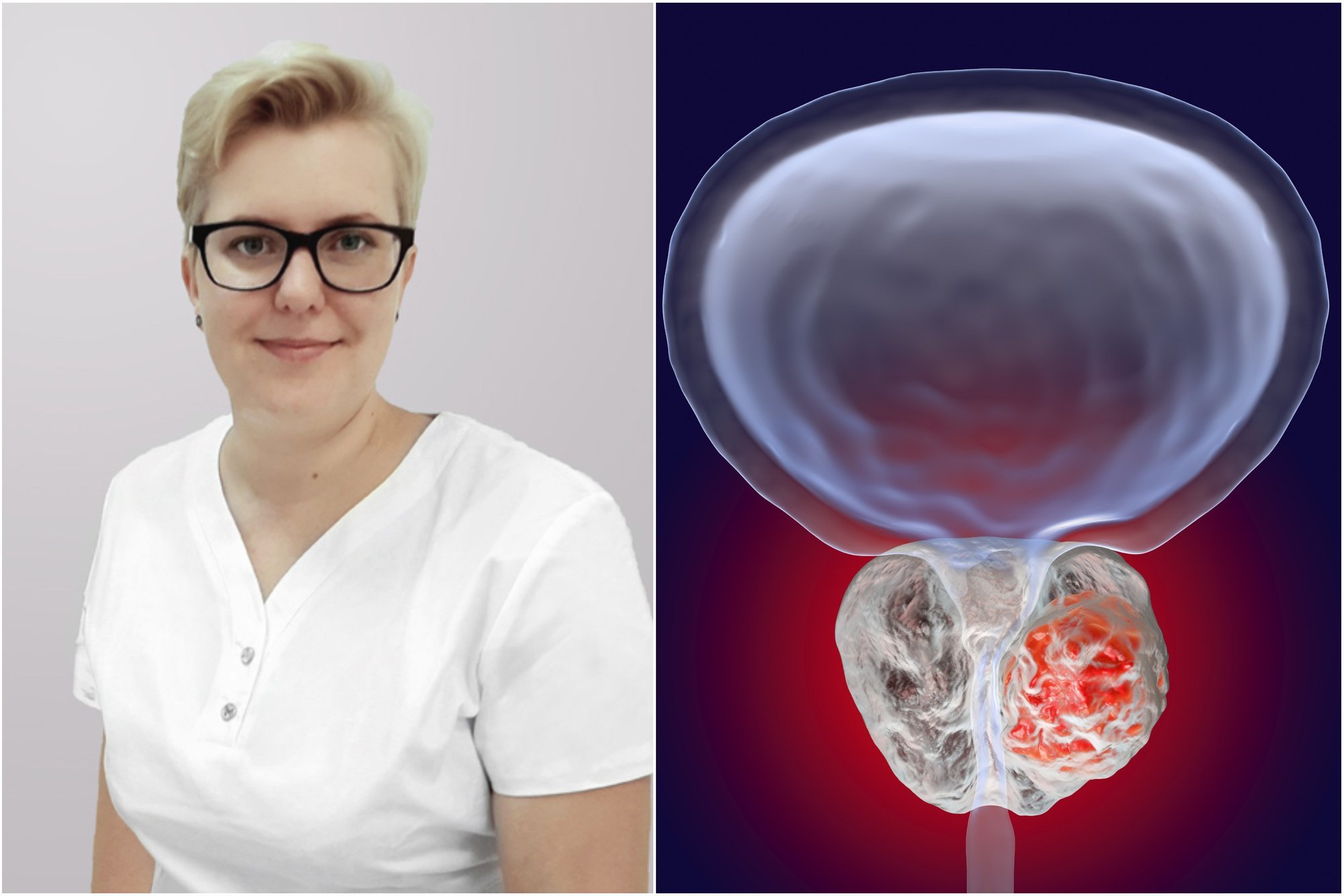 Prasti prostatos rodikliai nebūtinai rodo vėžį – kai kuriais atvejais ...