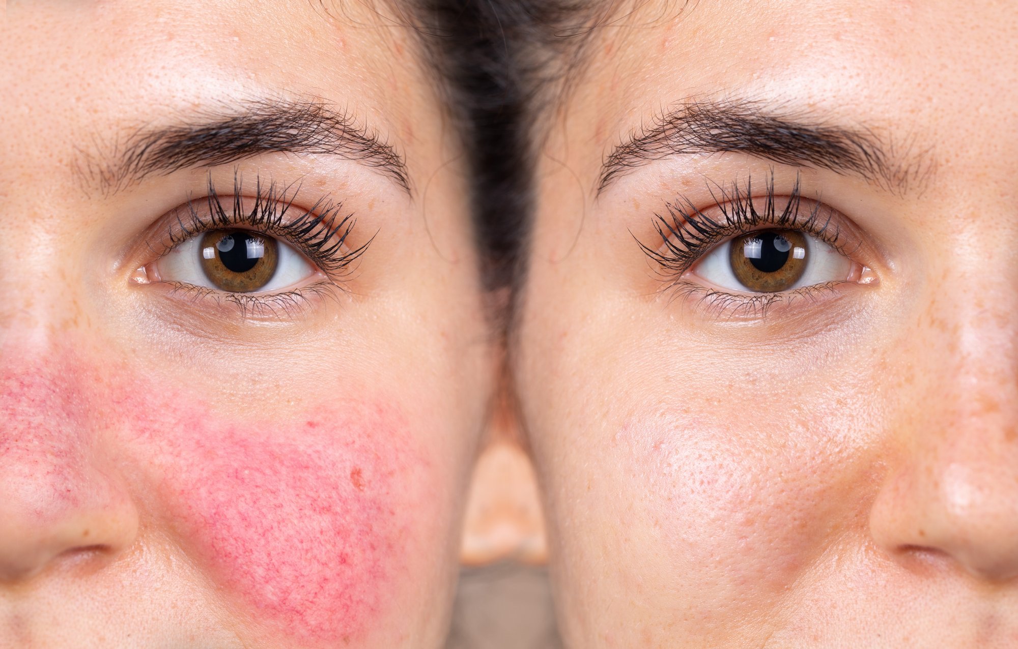Vargina veido raudonis ir išsiplėtę kapiliarai? Dermatologė paaiškino ...