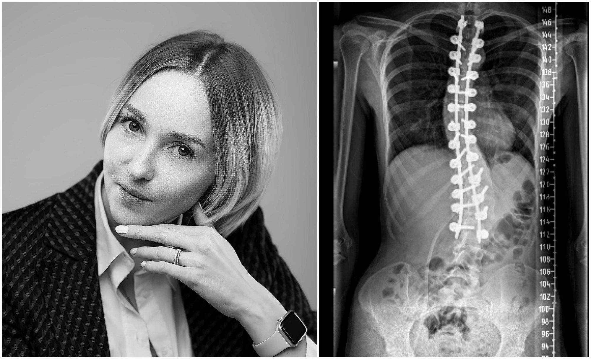 Po nelaimės Belgijoje moteriai sunkiai gijo stuburo žaizda: tikrąją ...