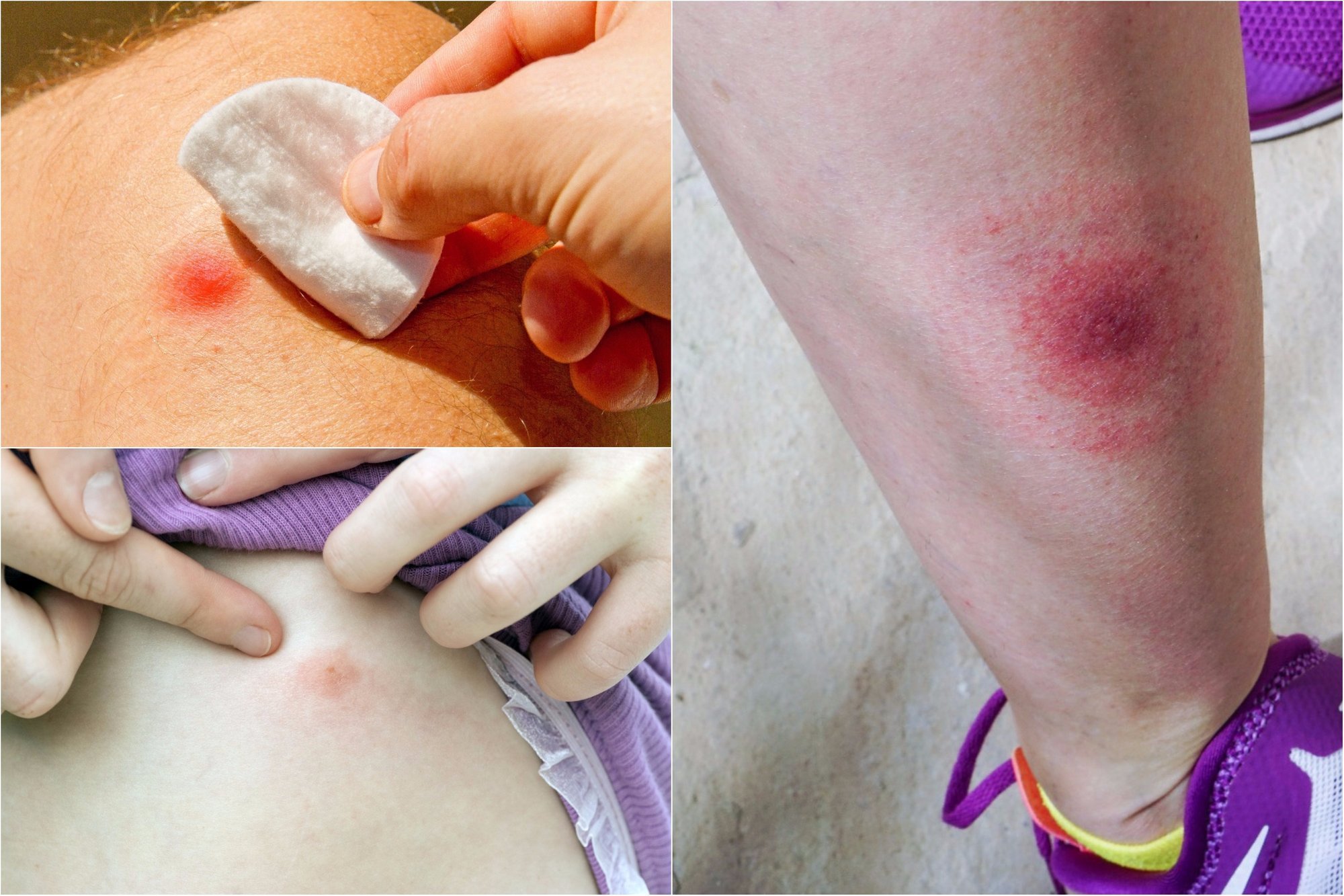 Pražūtingas raudonis: kaip atskirti, kas puotavo jūsų krauju - Delfi ...