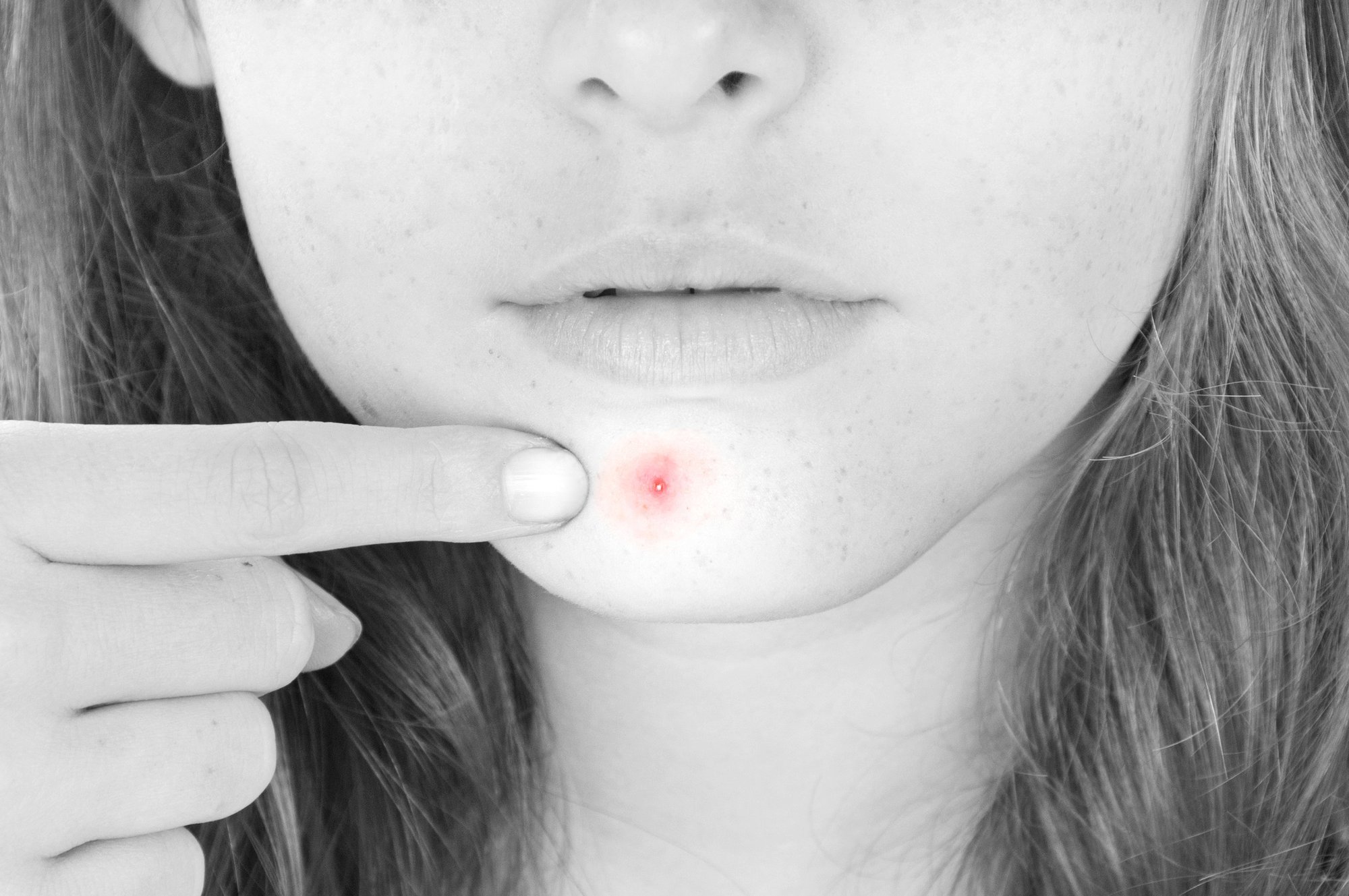 Prieš svarbų susitikimą atsirado spuogas? Būdai, kaip efektyviai jį ...