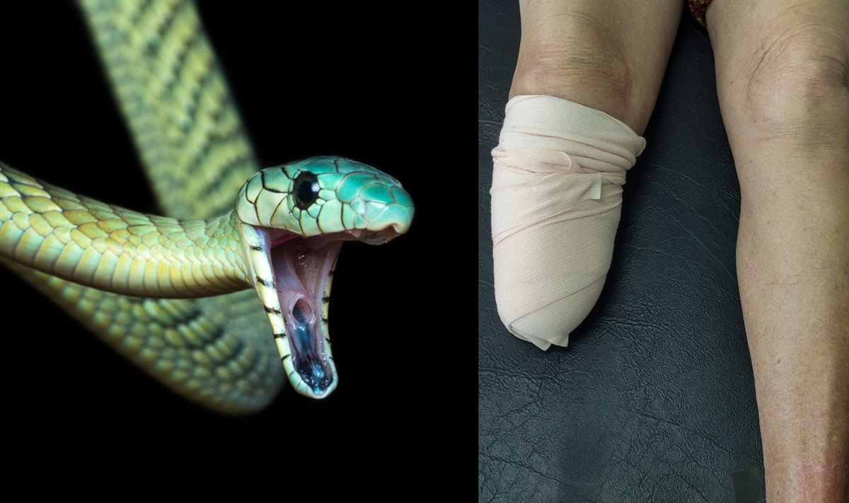 Po gyvatės įkandimo – nepagydomi sužalojimai ir galūnių amputacija ...